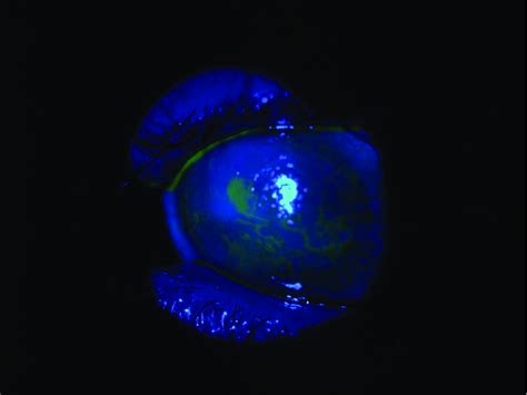 Examination Of Corneal Staining With Fluorescein Before Surgery