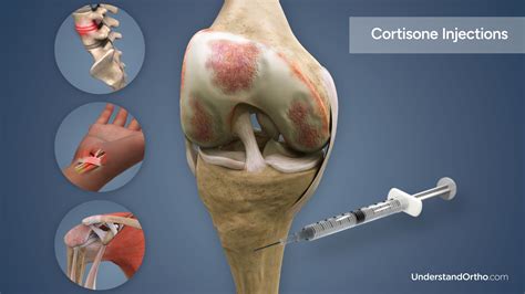 Cortisone Injection In Knee After Surgery At William Gainey Blog