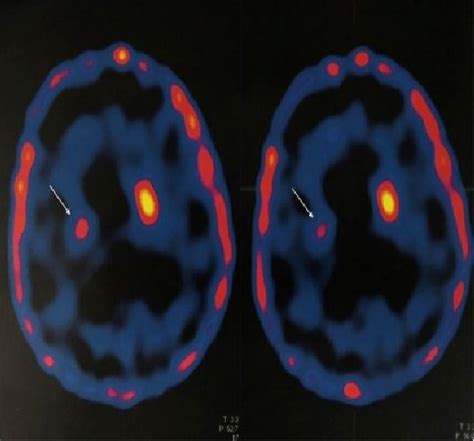 Figure 1 From Non Ketotic Hyperglycemia Presenting As Acute Hemiparkinsonism Semantic Scholar