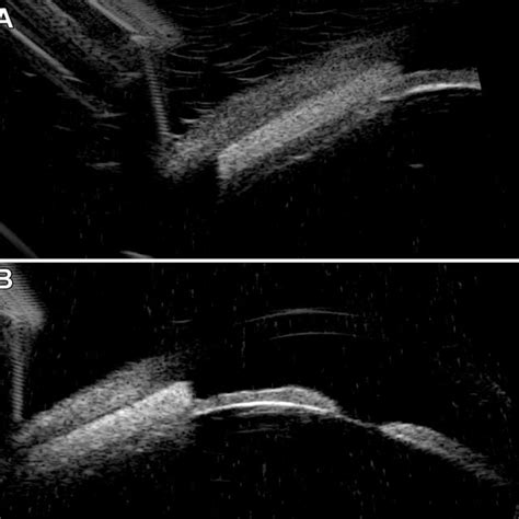 Miniject Glaucoma Drainage Device Istar Medical Sa Wavre Belgium