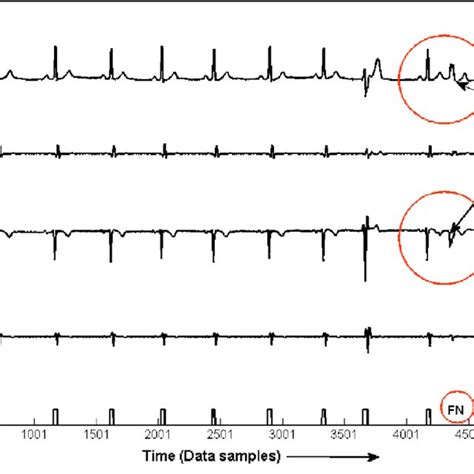 Qrs Detection In Record No 201 Of Mit Bih Arrhythmia Database
