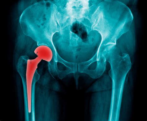 Metal On Metal Hip Replacement Lawsuits Continue Despite Recalls