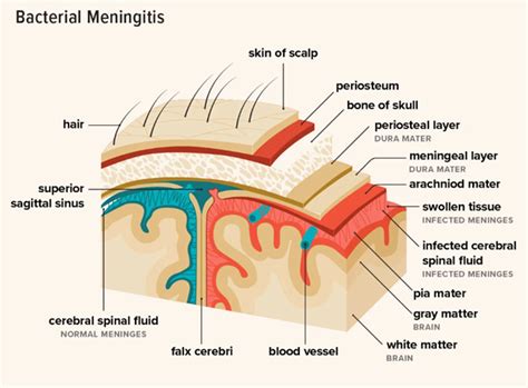Meningitis Outbreak All You Need To Know About Its Symptoms Causes