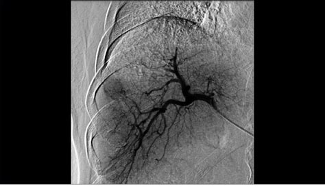 Pdf Chemoembolization As A Minimally Invasive Treatment Of Primary Malignant Liver Cancer