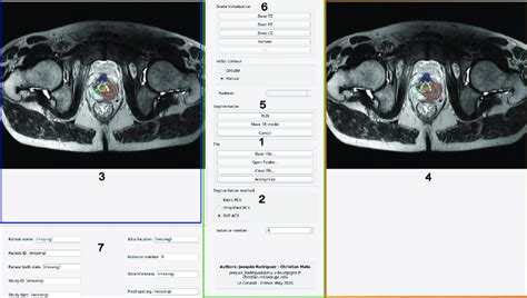 Gui Interface Of The Developed Active Contour Segmentation Tool Using A