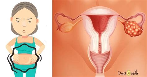 6 Commonly Missed Signs Of Ovarian Cancer The Silent Killer David