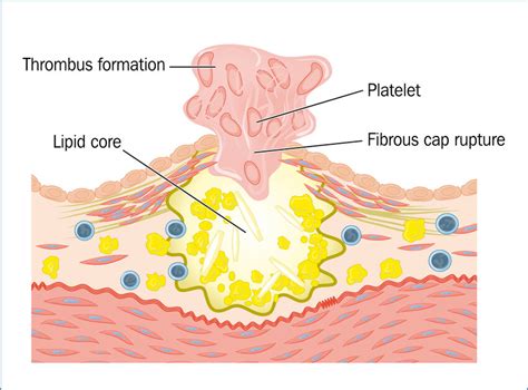 The St Segment In Red Starts At The J Point And Is Isoelectric With