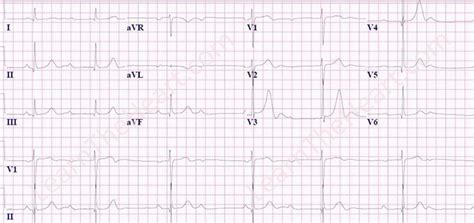 Second Degree Av Block Type I And 2 1 Av Block Ecg Learn The Heart