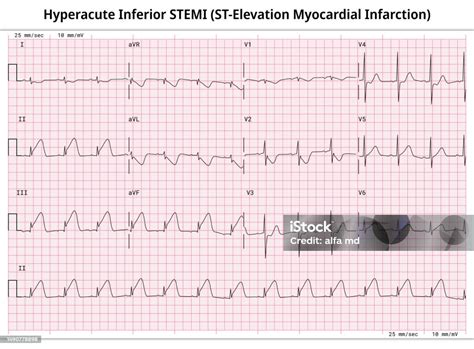 Ilustración De Iamcest Inferior Hiperagudo Caso Común De Ecg De 12