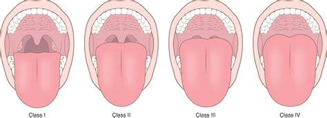 Airway Management Clinical Tree