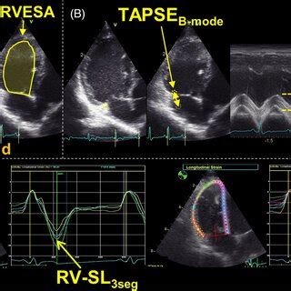 Echocardiographic Indices For RV Morphology And Function Measured In Download Scientific