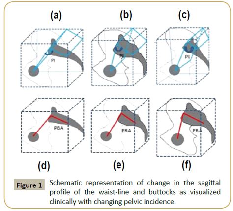 Pelvic Incidence Pi Is More Easily Understood As The Pelvic Base