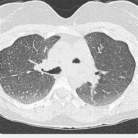 Diffuse Centrilobular Ground Glass Nodules Along The Bronchovascular Download Scientific