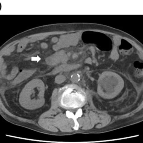 Abdominal Ct Image Showing Mesenteric Metastasis Arrow A Note That Download Scientific