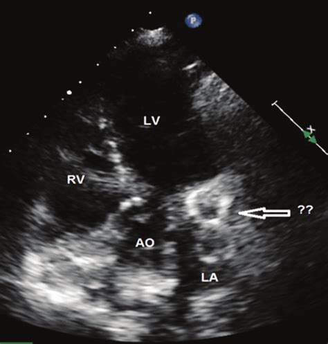 The Amplatzer Cardiac Plug Device Is An Alternative Non Surgical Method Download Scientific