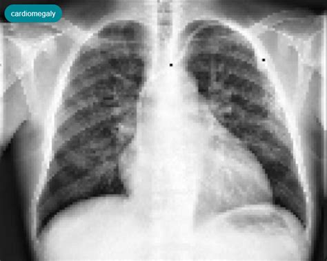 Cardiomegaly Detection In Chest X Rays Enhancing Cardiac Diagnostics With Computer Vision