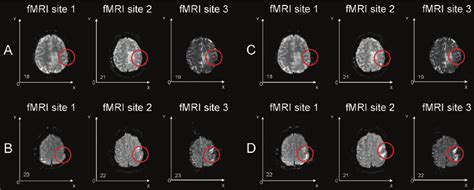 Intersite Variability Of Functional Localizations Shown For The Patient Download Scientific