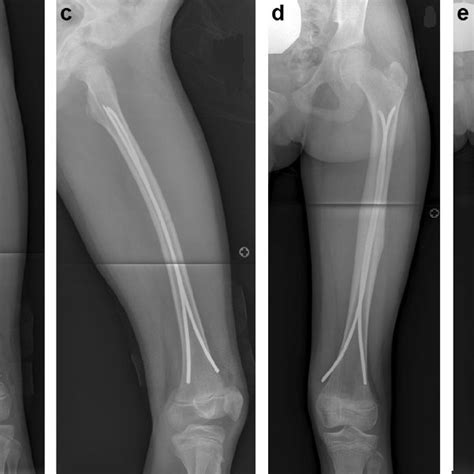 Pdf Complications Précoces Lors De Lutilisation Pour Fracture Chez Lenfant De Lenclouage