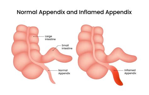Premium Vector Normal Appendix And Inflamed Appendix