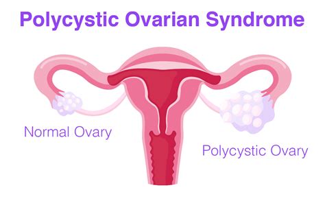 Is Pcos Infertility Premom India