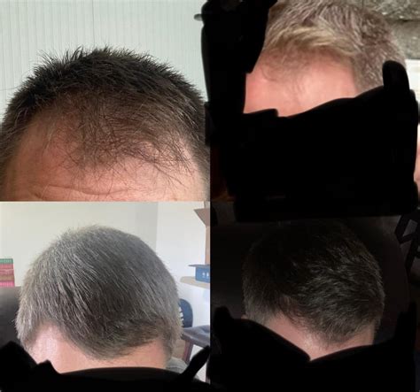 Its Been One Year Since I Started Minoxidil And Finasteride For My