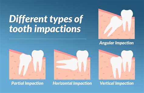 Wisdom Teeth Types