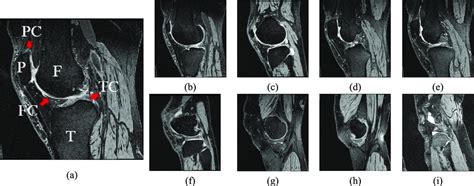 Knee Structure With Patella P Femur F Tibia T Patellar