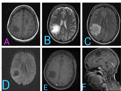 Hội Chứng Cotard Bệnh Tâm Thần Hiếm Gặp Nhưng Nguy Hiểm Là Gì Nguyên