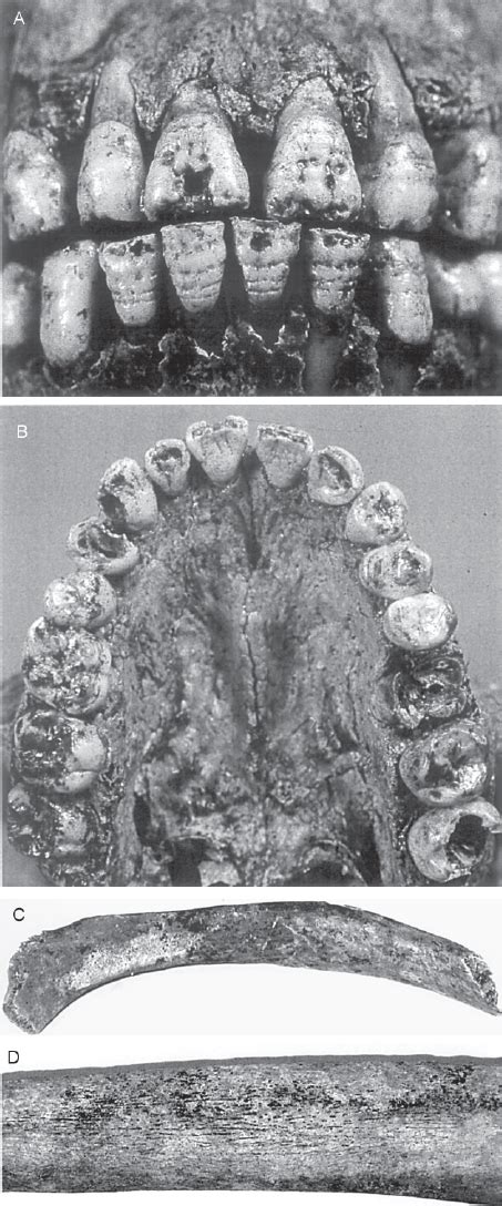 Dental And Skeletal Lesions Suggestive Of Congenital Syphilis And