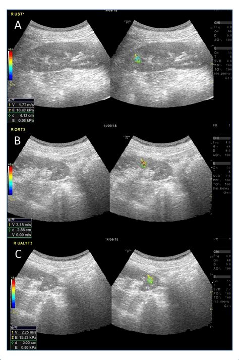 A C Examples Of Shear Wave Elastography Measurements Performed From