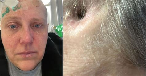 10년 전 상처 때문에 머리에 ‘구멍 난 英 40대 여성 사연 들어보니