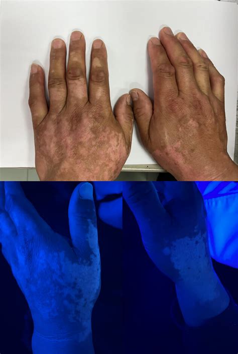 Chemical Leukoderma Induced By Pesticides Zhao 2024 Skin Research And Technology Wiley