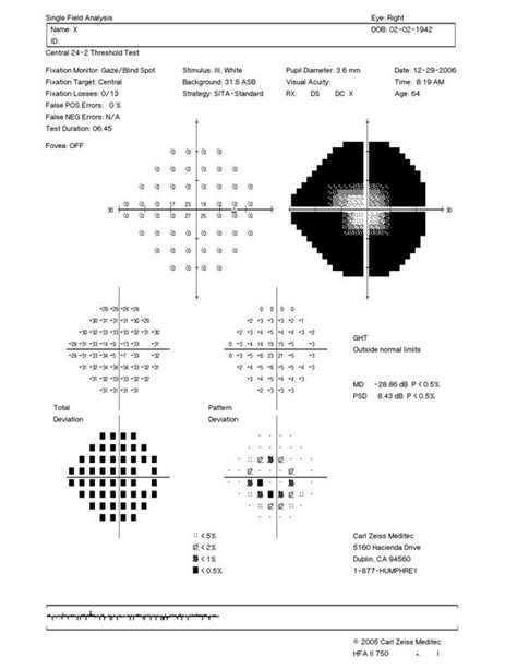 Visual Field Defects Chart Ponasa