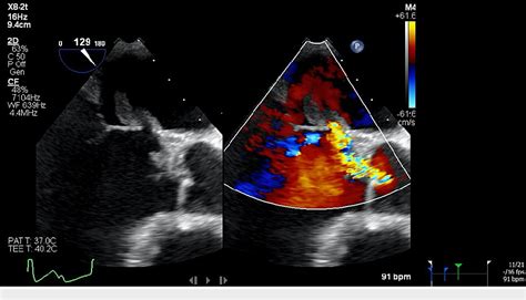 Figure 5 From Triple Valve Endocarditis With Aortic Root Abscess Presenting With Complete Heart