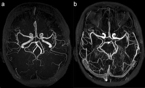 Mr Angiography Types A Time Of Flight Mr Angiography Tof Mra And B
