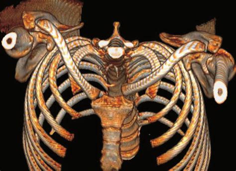 Three Dimensional Computerized Tomography Image Of The Posterior