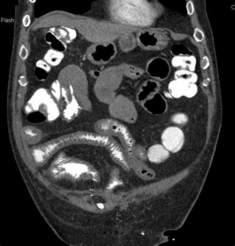 Small Bowel Enteritis Small Bowel Case Studies Ctisus Ct Scanning