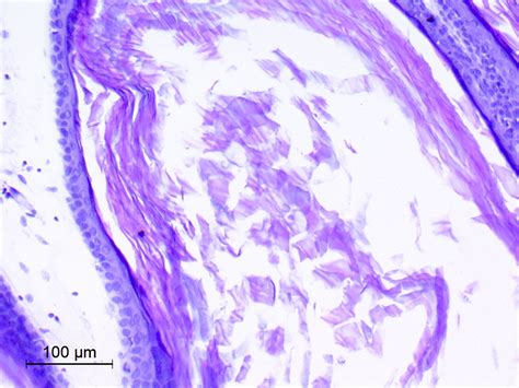Pathology Outlines Ectodermal Cysts