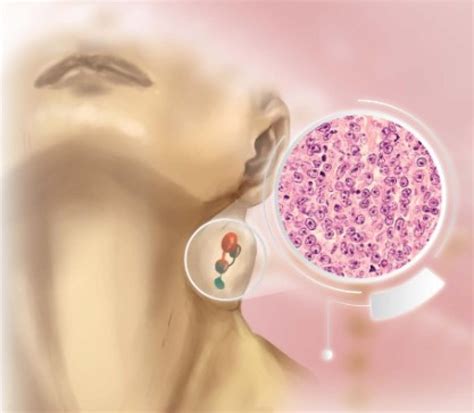 Pemeriksaan Untuk Limfoma Hodgkin Dan Non Hodgkin