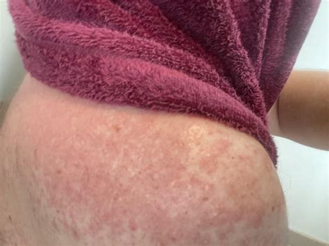 Do Yall Think This Is Dermatitis Back Is Always Itchy So Is The Middle Of My Chest And Above