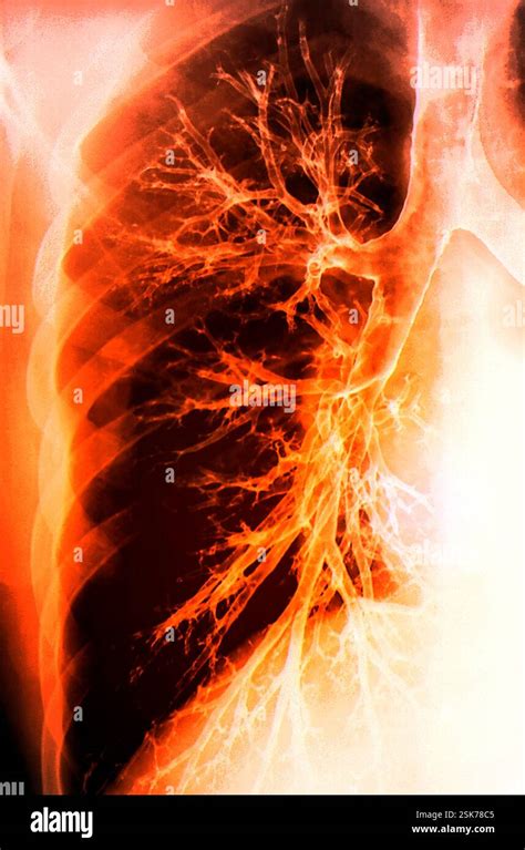 Coloured X Ray Bronchogram In Side View Of The Chest Of A Patient Showing A Healthy Right