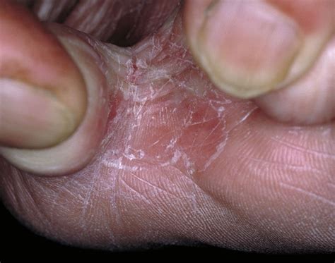 How Do Athletes Feet Look Athletes Foot Mxqd