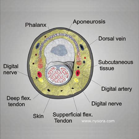 Blocking Digital Nerve Digital Nerve Block Procedure Mdef