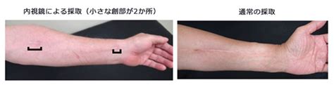 橈骨動脈圧迫 橈骨動脈が触れない場合 橈骨動脈カテーテル挿入 Fqfhtv