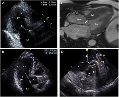 Morphologic Abnormalities Of Mitral Valve Contributing To Outflow Tract Download Scientific