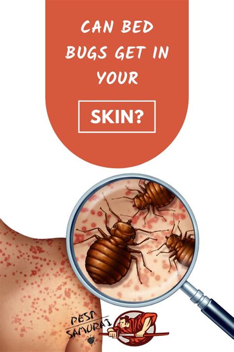Bed Bugs On Skin Can Bed Bugs Get In Your Skin Bed Bugs Rid Of Bed