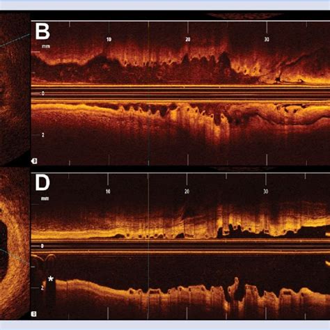 A 70 Year Old Woman Presented An Inferior St Segment Elevation