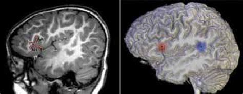 A And B Normal Anatomy A Sagittal T1w Image Shows Two Sulcal Download Scientific Diagram