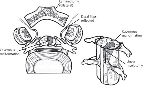 Spinal Cord Cavernous Malformations Neupsy Key