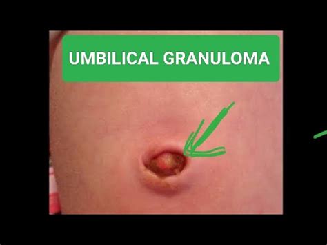 Umbilical Granuloma Differentiation Between Umbilical Granuloma And
